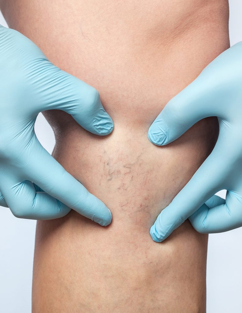 Pigmentation & Vascular Removal - Aramed